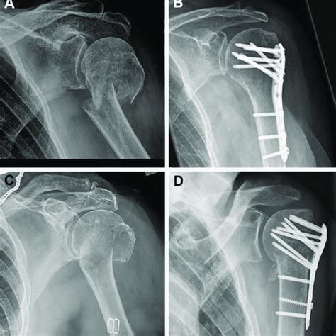 Pdf Open Reduction And Internal Fixation Of Displaced Proximal