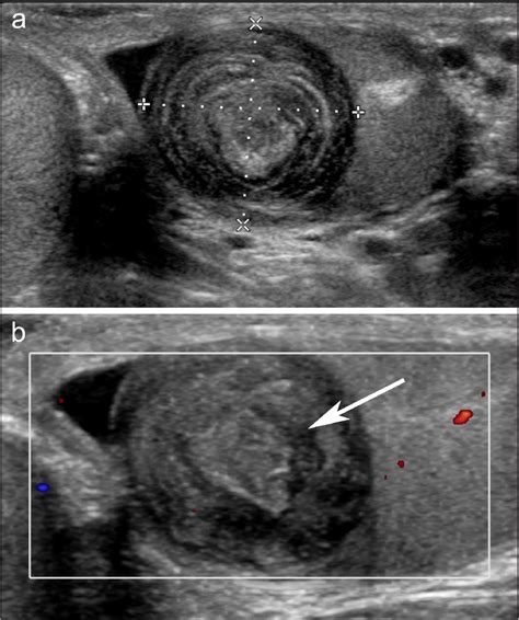 Figure 1 From Intrascrotal Testicular And Extratesticular Epidermoid