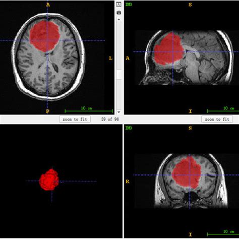 Manual Segmentation Of Glioma Using Itk Snap Download Scientific Diagram