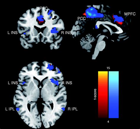 Resting State Connectivity Between Default Mode Network And Insula