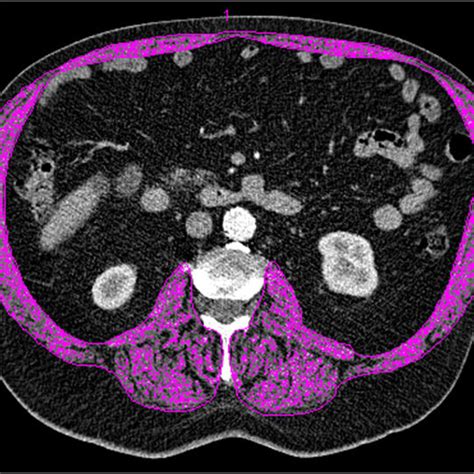 Example Of A Computed Tomography Ct Scan With The Area Based