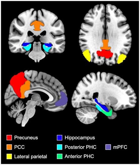 Frontiers Altered Resting State Functional Connectivity Patterns In