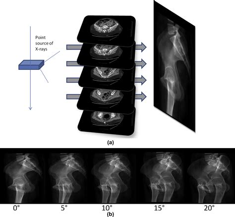 Influence Of Patient Rotational Malpositioning On Pelvic Parameters