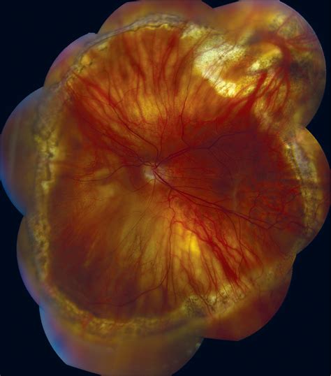 pars plana vitrectomy for primary retinal detachmentpersistent anterior