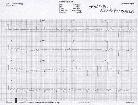atrial flutter ecg photograph by science source pixels