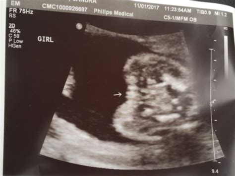 can the 20 wk gender ultrasound be wrong march 2018 birth club