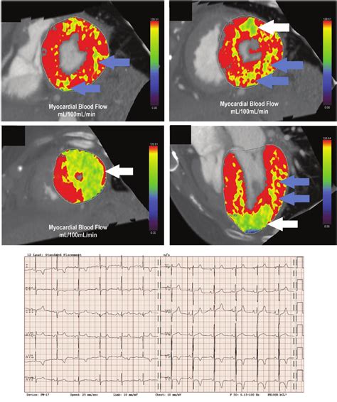 Computed Tomography Perfusion And Electrocardiography A D Dynamic