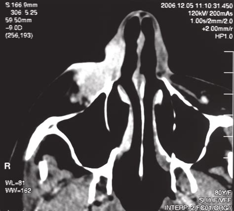 Pre Operative Contrast Ct Shows Neoplasm Involving Naso Genial Region