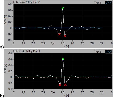 Figure 4 From Qrs Time Detection Using Wavelet Multiresolution Analysis
