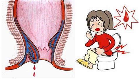 Rectal Prolapse Vs Hemorrhoid
