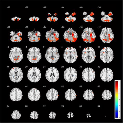 Brain Regions With Significant Gmv Abnormalities For The Patients With