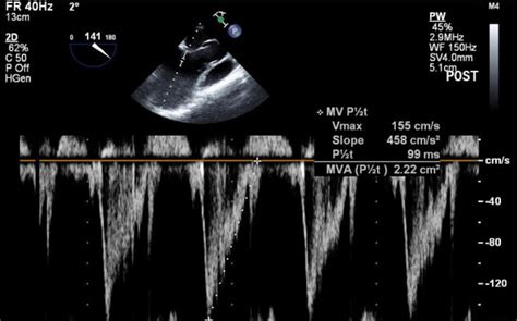 determination of mitral valve area using pressure half time with