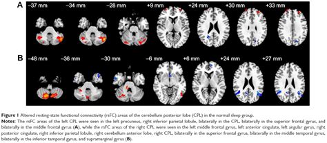 Connectivity Pattern Differences Bilaterally In The Cerebellum Posteri