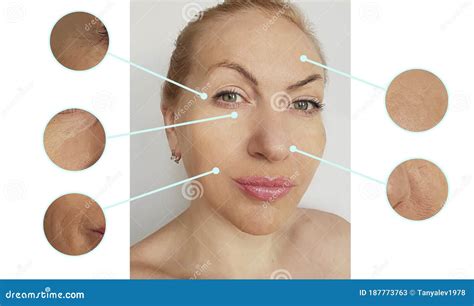Woman Face Wrinkles Before Freckles Problem Removal Correction Effect
