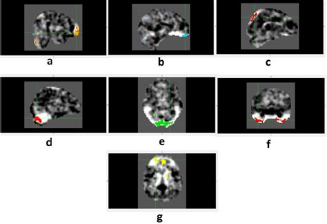 Figure 1 From Altered Resting State Functional Connectivity Patterns Of