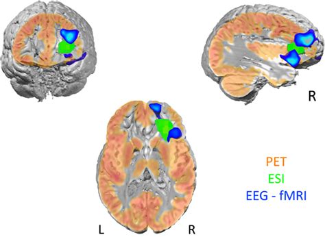 Multimodal Functional Imaging Approach To Localize The Epileptic Focus
