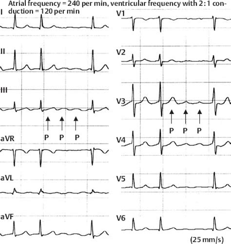 Atypical Atrial Flutter