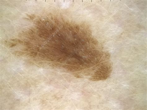 Seborrheic Keratosis Dermoscopy Stock Image C056 3231 Science