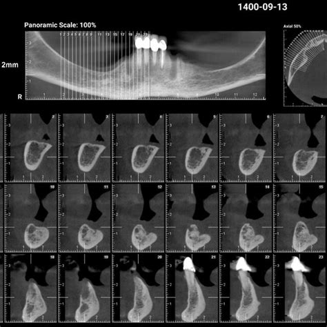 2 Year Cone Beam Computed Tomography Cbct Follow Up Shows Healing At