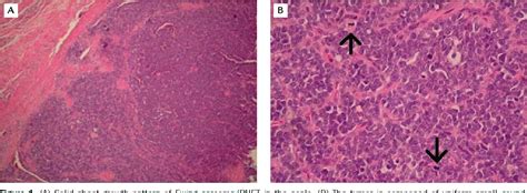 Figure 1 From Primary Vaginal Extraosseous Ewing Sarcoma Primitive