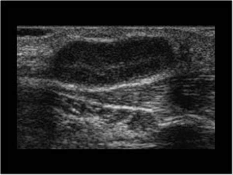 head and neck 4 4 lymph nodes case 4 4 2 malignant