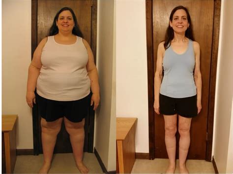 Gastric Sleeve Before And After Pictures And What You Can Expect