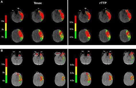 Frontiers A Comparison Of Relative Time To Peak And Tmax For Mismatch