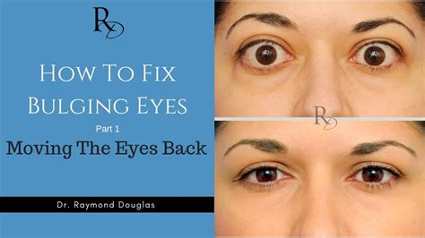 how to fix bulging eyes part 1 moving the eyes back tips of the
