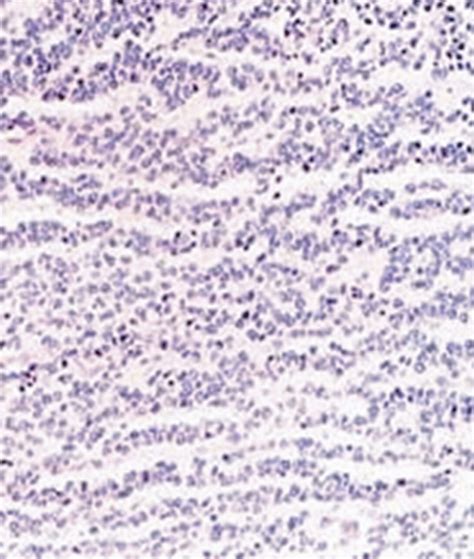 Radiologic Findings Of Peripheral Primitive Neuroectodermal Tumor