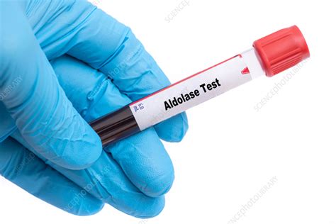 Aldolase Test Conceptual Image Stock Image F037 0365 Science