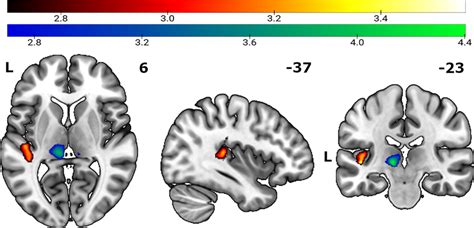 Voxel‐based Morphometry Analysis This Figure Displays The Clusters