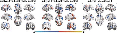 The Group Differences In Gray Matter In The Informative Ics Across