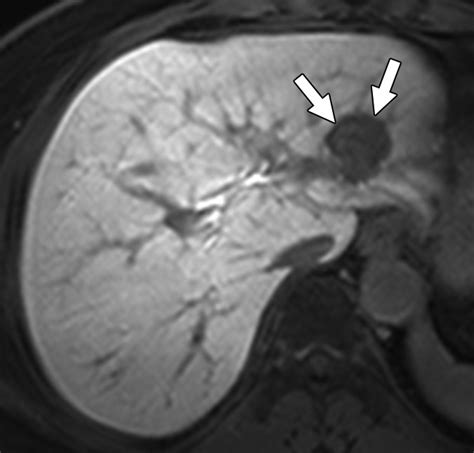Cross Sectional Imaging Of Intrahepatic Cholangiocarcinoma Development