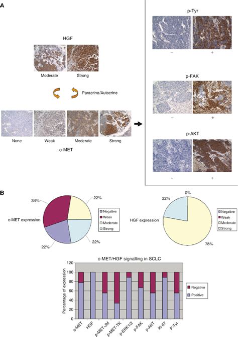 Tumour Tissue Microarray Analysis Of C Met Hgf Signalling A Examples