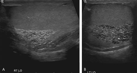 Tubular Ectasia Of Rete Testis Longitudinal Gray Scale Sonograms Of