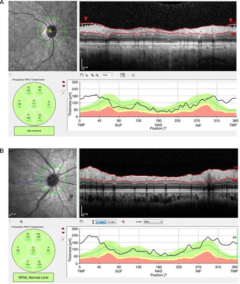 influence of epiretinal membrane on the measurement of peripapillary