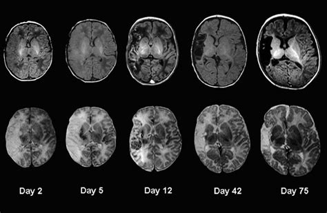 Images Show The Temporal Evolution Of A Right Sided Main Branch Mca