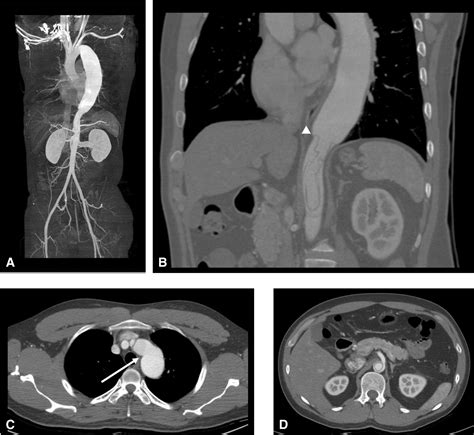 Aortic Intimointimal Intussusception In Chronic Type B Dissection