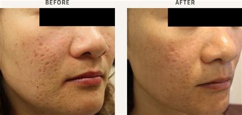 Fractional Laser Treatment Sydney Dermatology Group