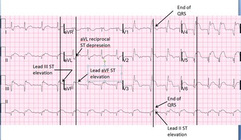 Dr Smiths Ecg Blog Subacute Anteroseptal Stemi With Persistent St