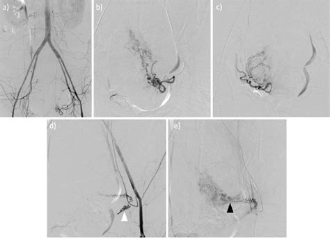 Figure 2 From Successful Embolization Of Collaterals From The Round