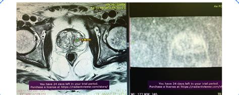 Two Mpmri Sequences Of Prostate With A Pi Rads 4 Lesion Of The