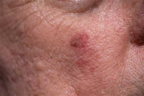 Popular Treatment Options For Actinic Keratoses A2z Healthy