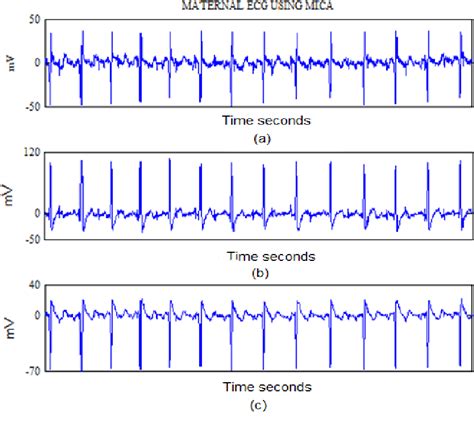 Figure 4 From An Algorithm For Extracting Non Invasive Fetal Ecg From