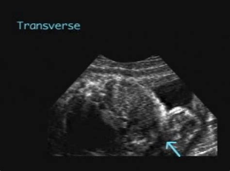 Jejunal Atresia Ultrasoundpaedia