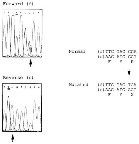 Sequence Gel Electropherograms Showing A C→t Point Mutation R39x In A