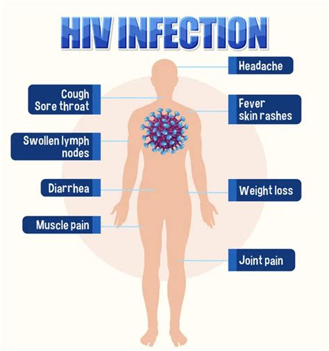 Informative Poster Common Symptoms Hiv Illustration Stock Illustration