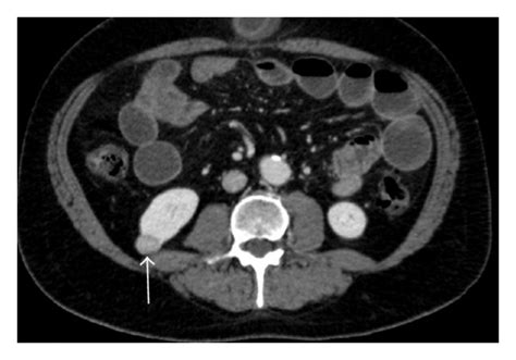 Chromophobe Carcinoma A B Contrast Enhanced Ct Scans In Arterial