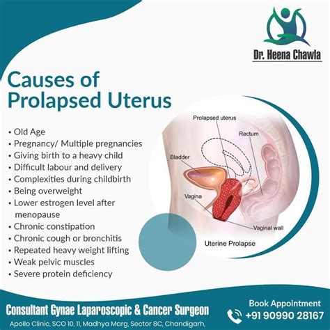 Causes Of Prolapsed Uterus Prolapsed Uterus Uterine Prolapse Lower