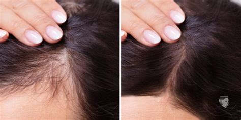 Anxiety And Stress Leading Hair Loss Ahs India